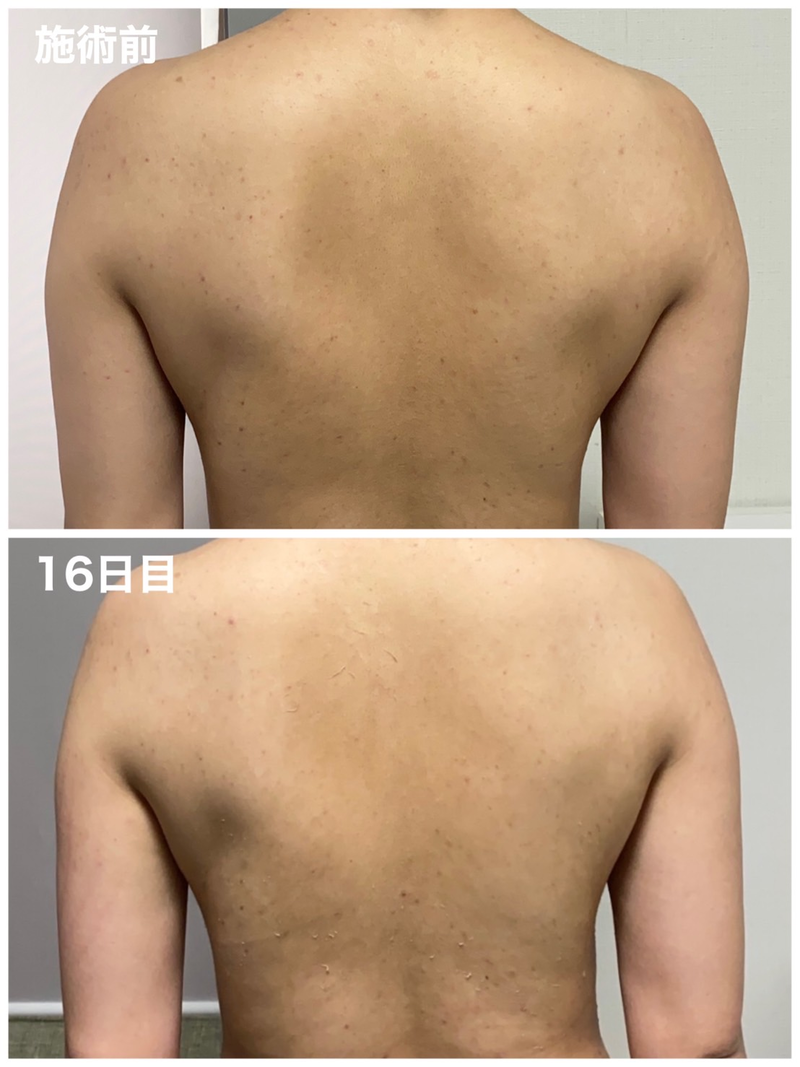 背中ミラノリピール体験ブログ【グローバルビューティークリニック東京院】 | ふつう女子の美容日記